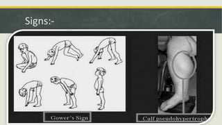 Duchenne Muscular Dystophy ppt | PPT
