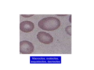 Interpretación hemograma | PPT | Blood Disorders | Diseases and Conditions