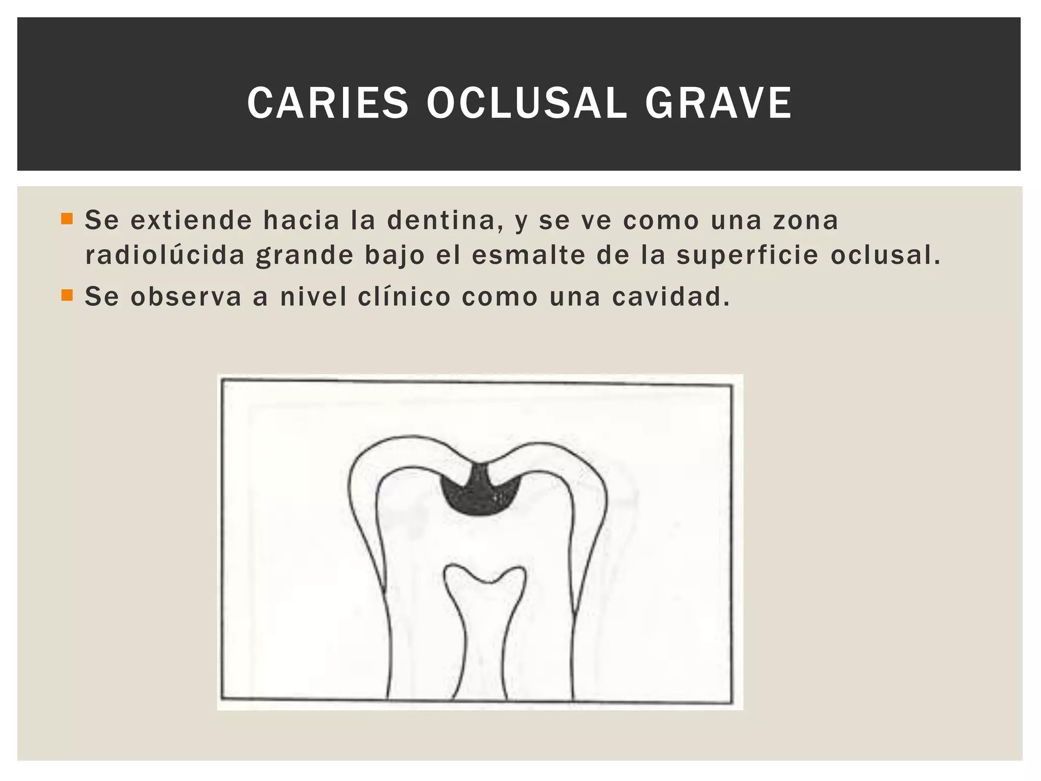 interpretaciones rx cariesInterpretaciondelacariesdentalexpofinalmajo ...