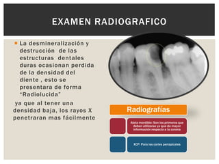 Interpretacion caries dental en Radiologia | PPTX