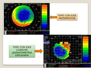 Interpretación básica de la Topografía Corneal | PPTX