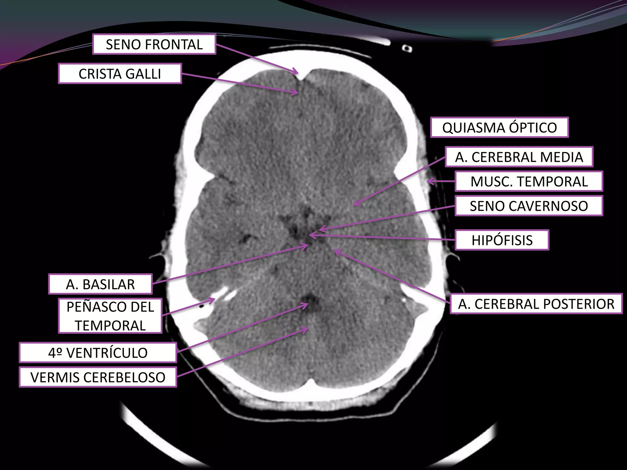 INTERPRETACION DE ANATOMIA CEREBRAL EN UNA TAC CRANEAL | PPTX
