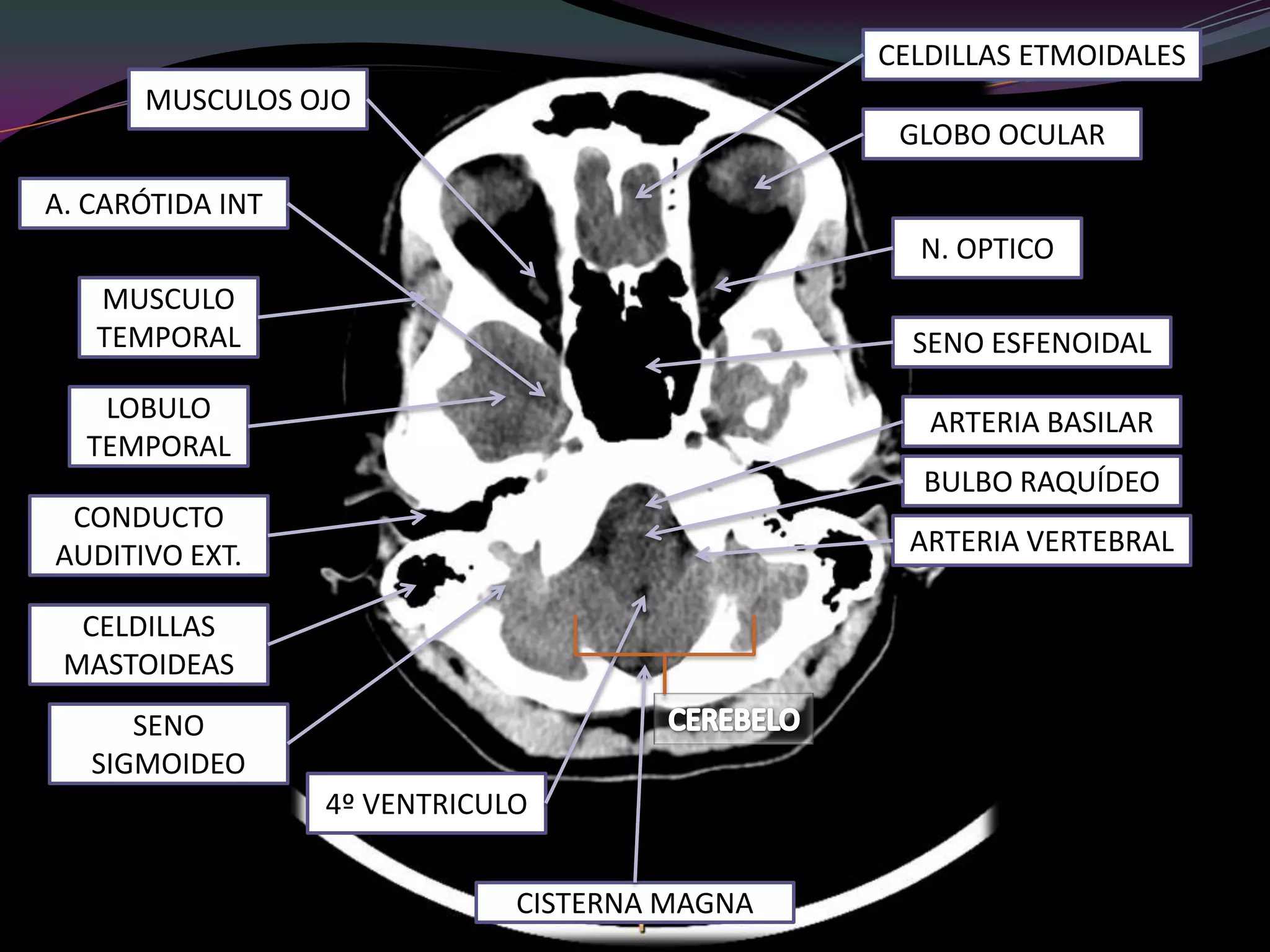 INTERPRETACION DE ANATOMIA CEREBRAL EN UNA TAC CRANEAL | PPTX