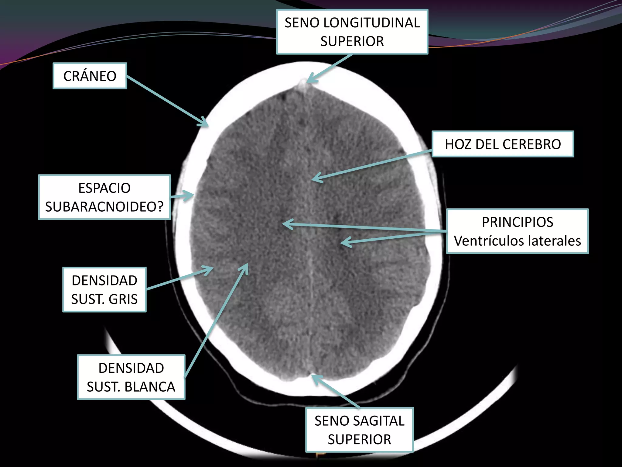 INTERPRETACION DE ANATOMIA CEREBRAL EN UNA TAC CRANEAL | PPTX