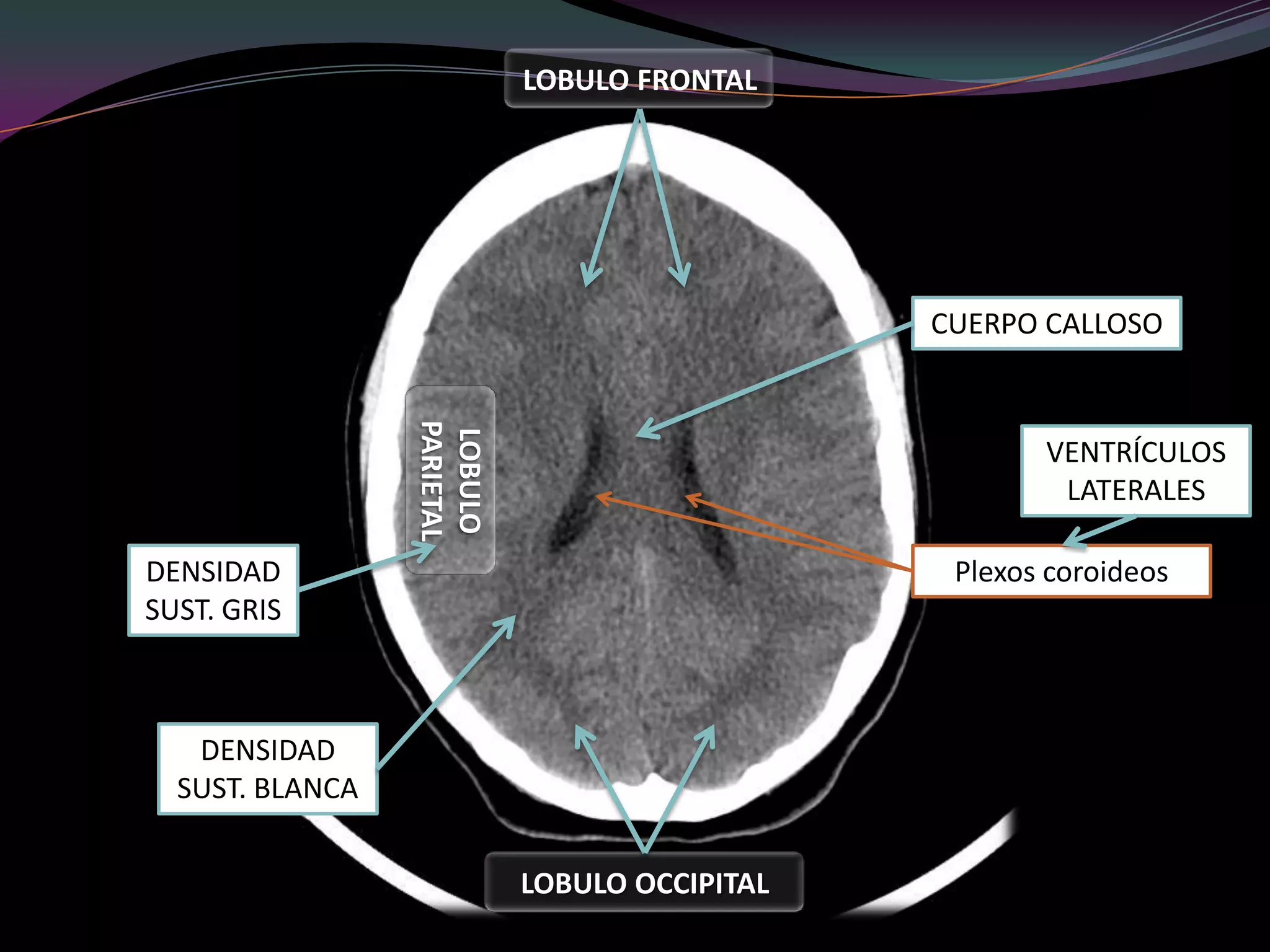INTERPRETACION DE ANATOMIA CEREBRAL EN UNA TAC CRANEAL | PPTX