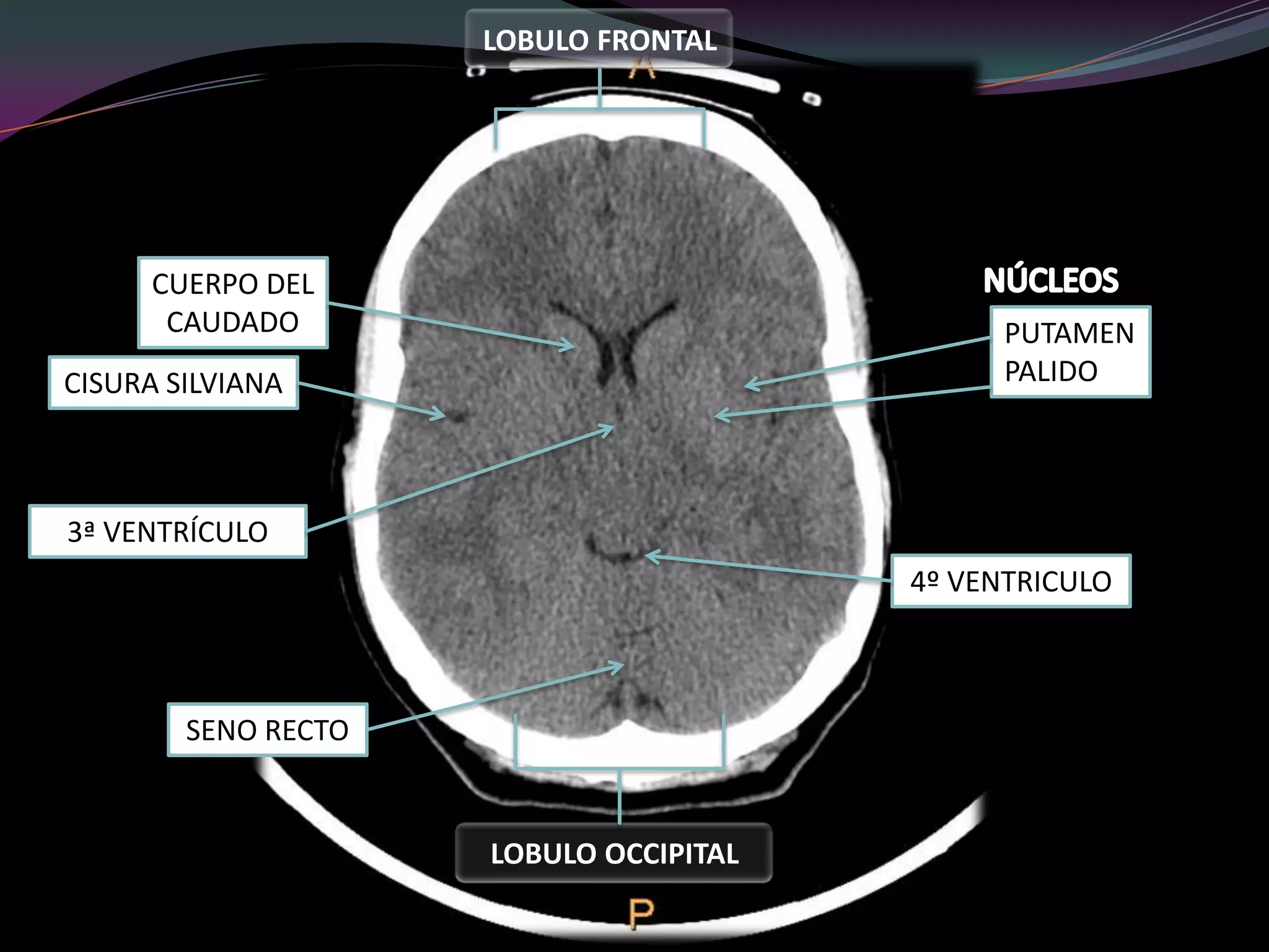 INTERPRETACION DE ANATOMIA CEREBRAL EN UNA TAC CRANEAL | PPTX