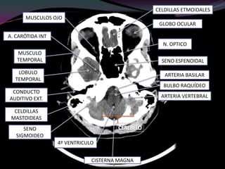 INTERPRETACION DE ANATOMIA CEREBRAL EN UNA TAC CRANEAL | PPTX