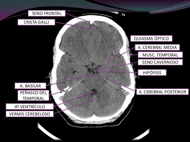 INTERPRETACION DE ANATOMIA CEREBRAL EN UNA TAC CRANEAL