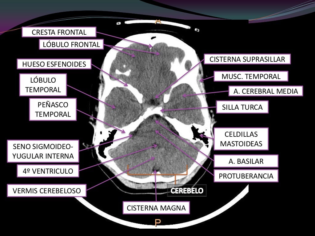 INTERPRETACION DE ANATOMIA CEREBRAL EN UNA TAC CRANEAL