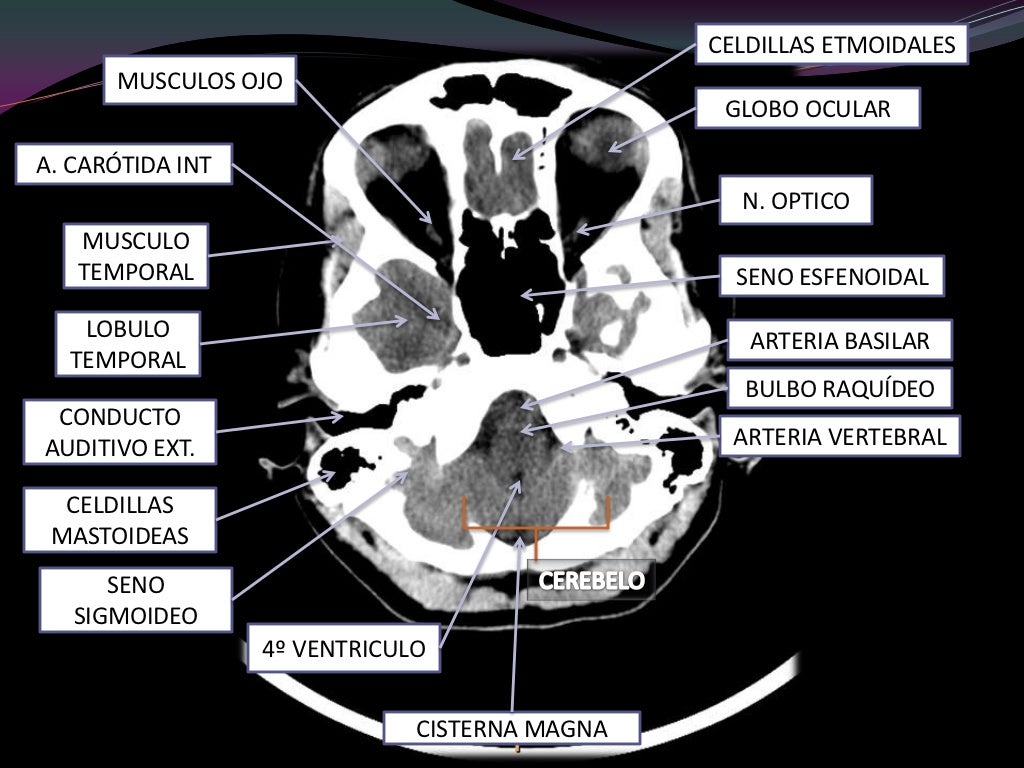 INTERPRETACION DE ANATOMIA CEREBRAL EN UNA TAC CRANEAL