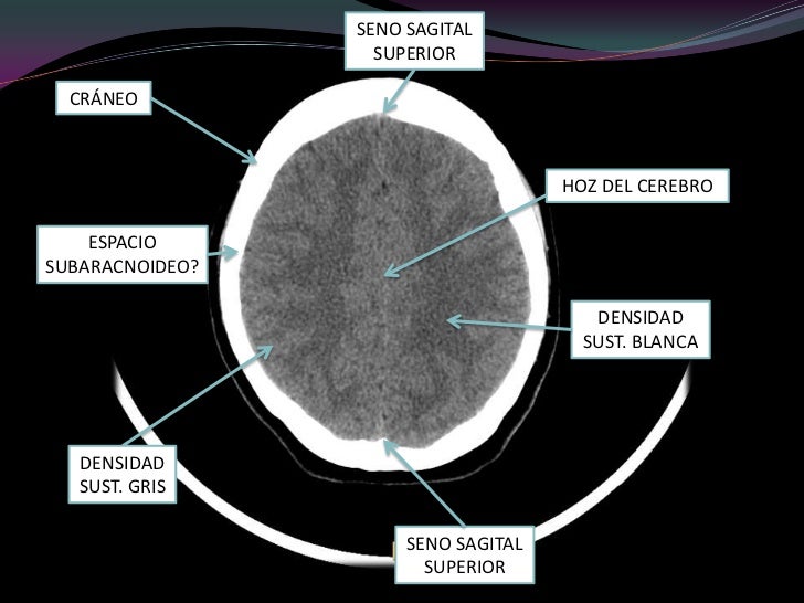 INTERPRETACION DE ANATOMIA CEREBRAL EN UNA TAC CRANEAL