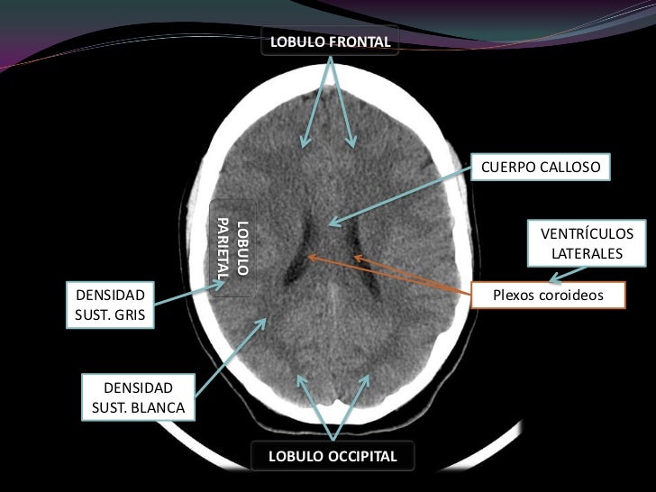 INTERPRETACION DE ANATOMIA CEREBRAL EN UNA TAC CRANEAL