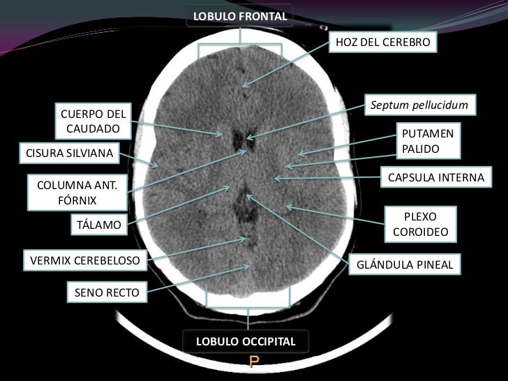 INTERPRETACION DE ANATOMIA CEREBRAL EN UNA TAC CRANEAL