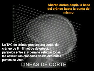 Interpretacion De Tac De Cráneo Fase Simple Pdf