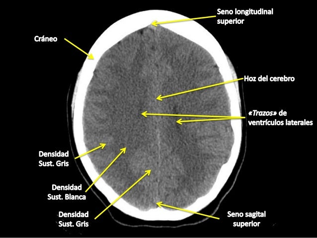 Interpretacion de TAC de CRÁNEO fase simple