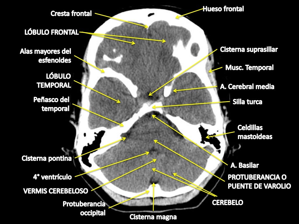 Interpretacion de TAC de CRÁNEO fase simple