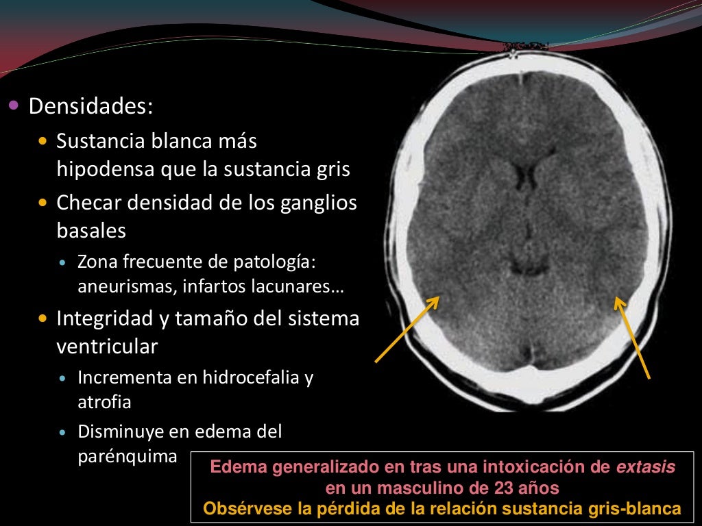 Interpretacion de TAC de CRÁNEO fase simple