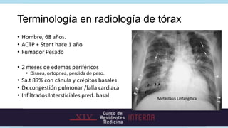 Interpretacion Rx de tórax | PPTX