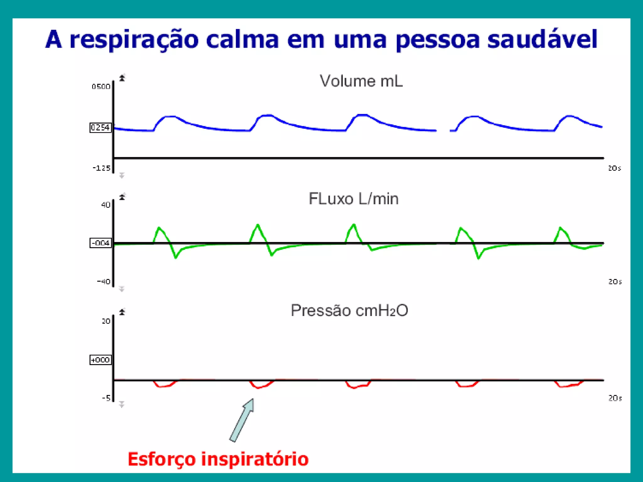 Interpretação de curvas e loops em ventilação mecânica | PPT