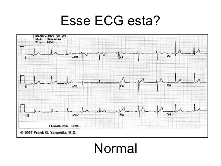 Interpretação de ECG