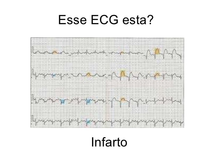 Interpretação de ECG