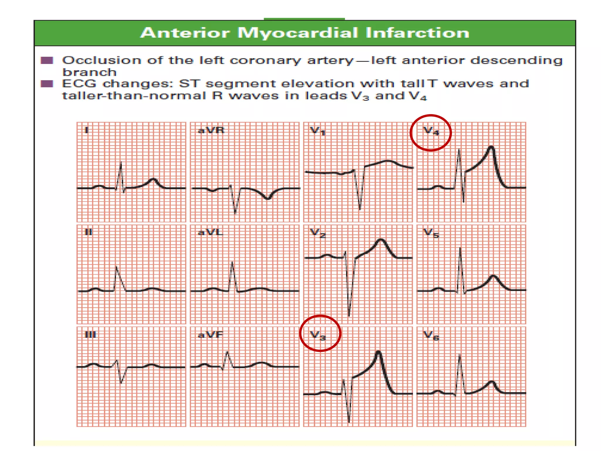 INTERPRETASI EKG 12 LEADS Infarct & Ischemia.pptx