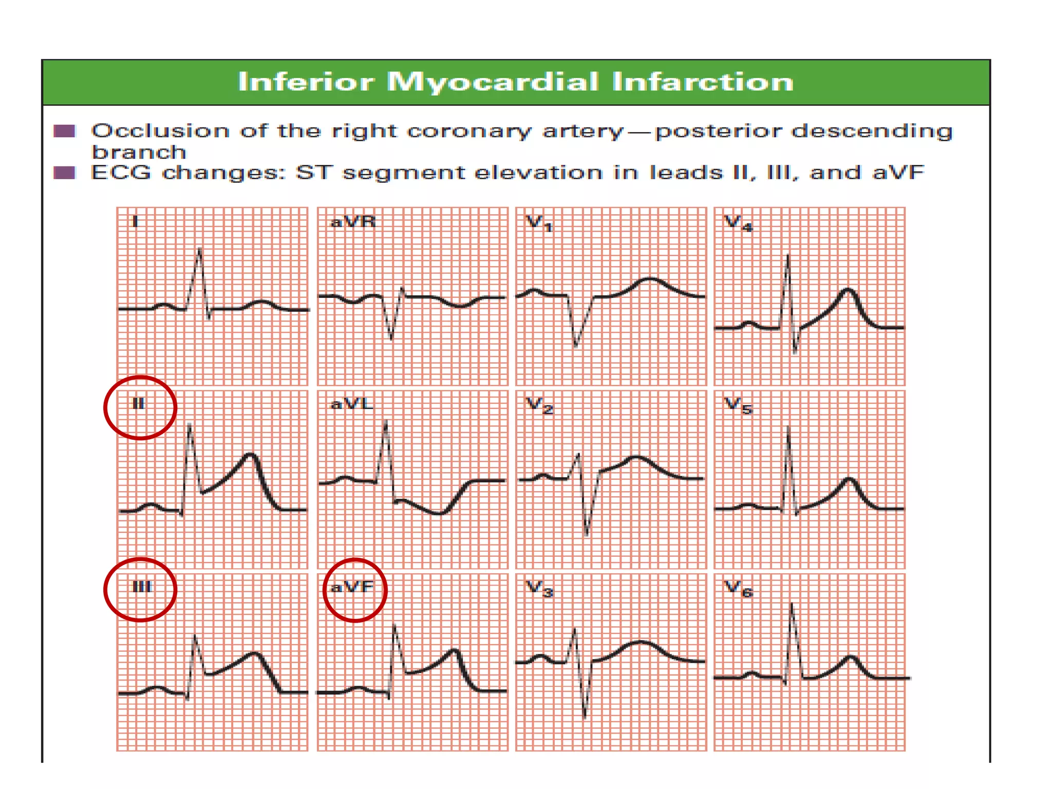 INTERPRETASI EKG 12 LEADS Infarct & Ischemia.pptx