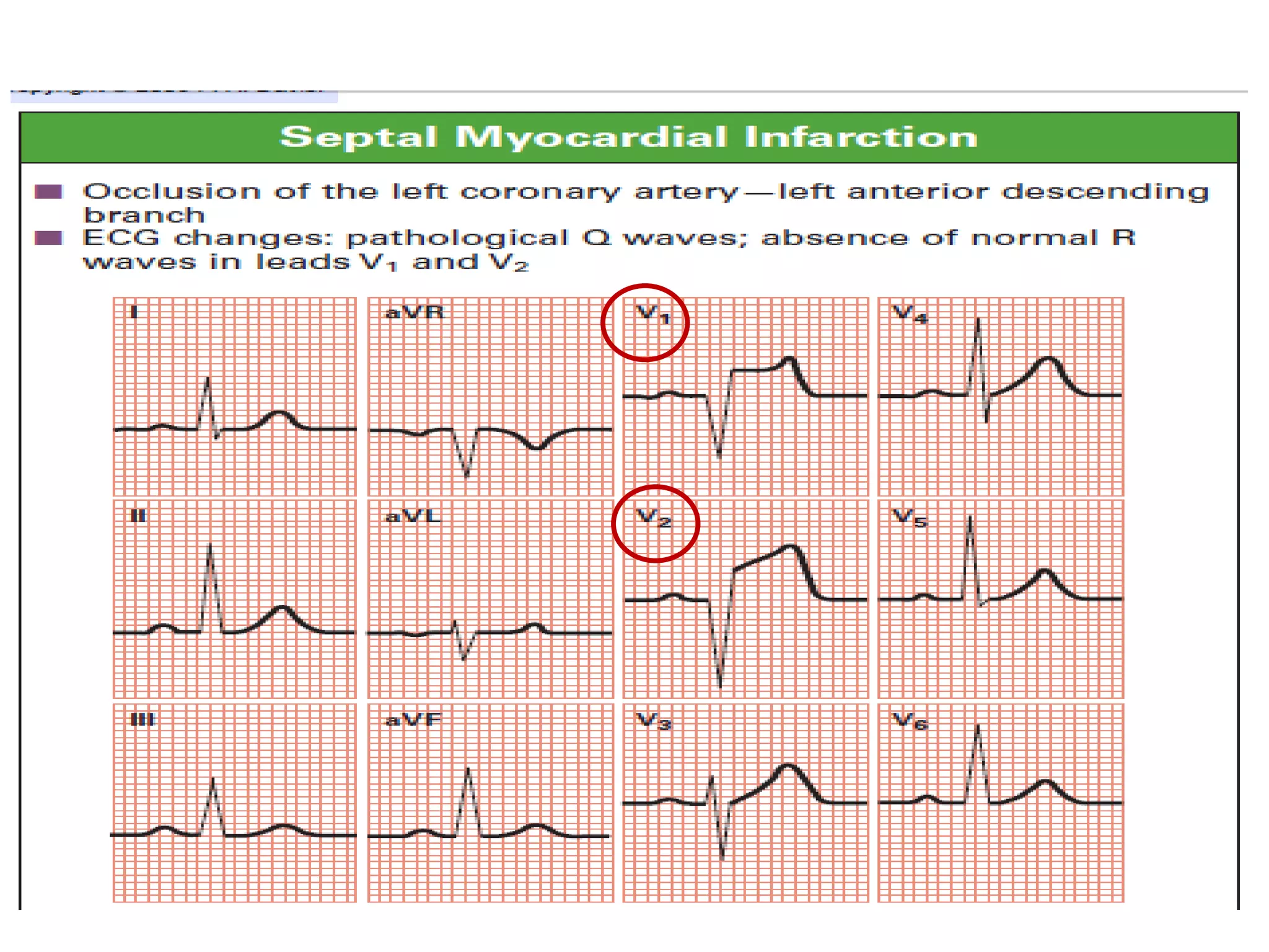 INTERPRETASI EKG 12 LEADS Infarct & Ischemia.pptx