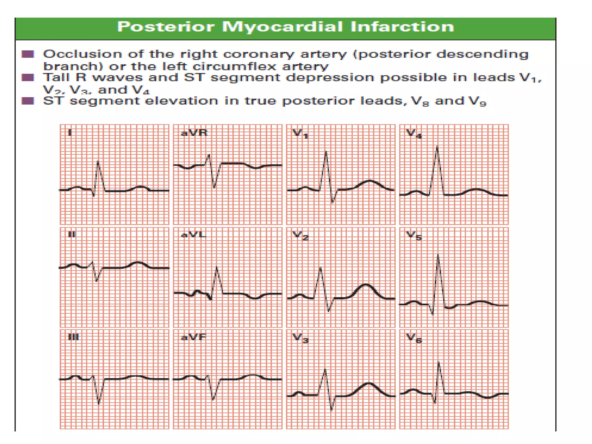 INTERPRETASI EKG 12 LEADS Infarct & Ischemia.pptx