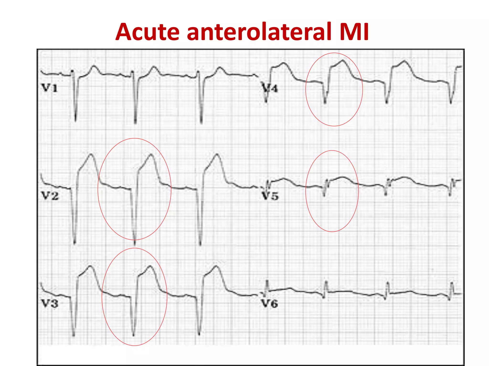 INTERPRETASI EKG 12 LEADS Infarct & Ischemia.pptx