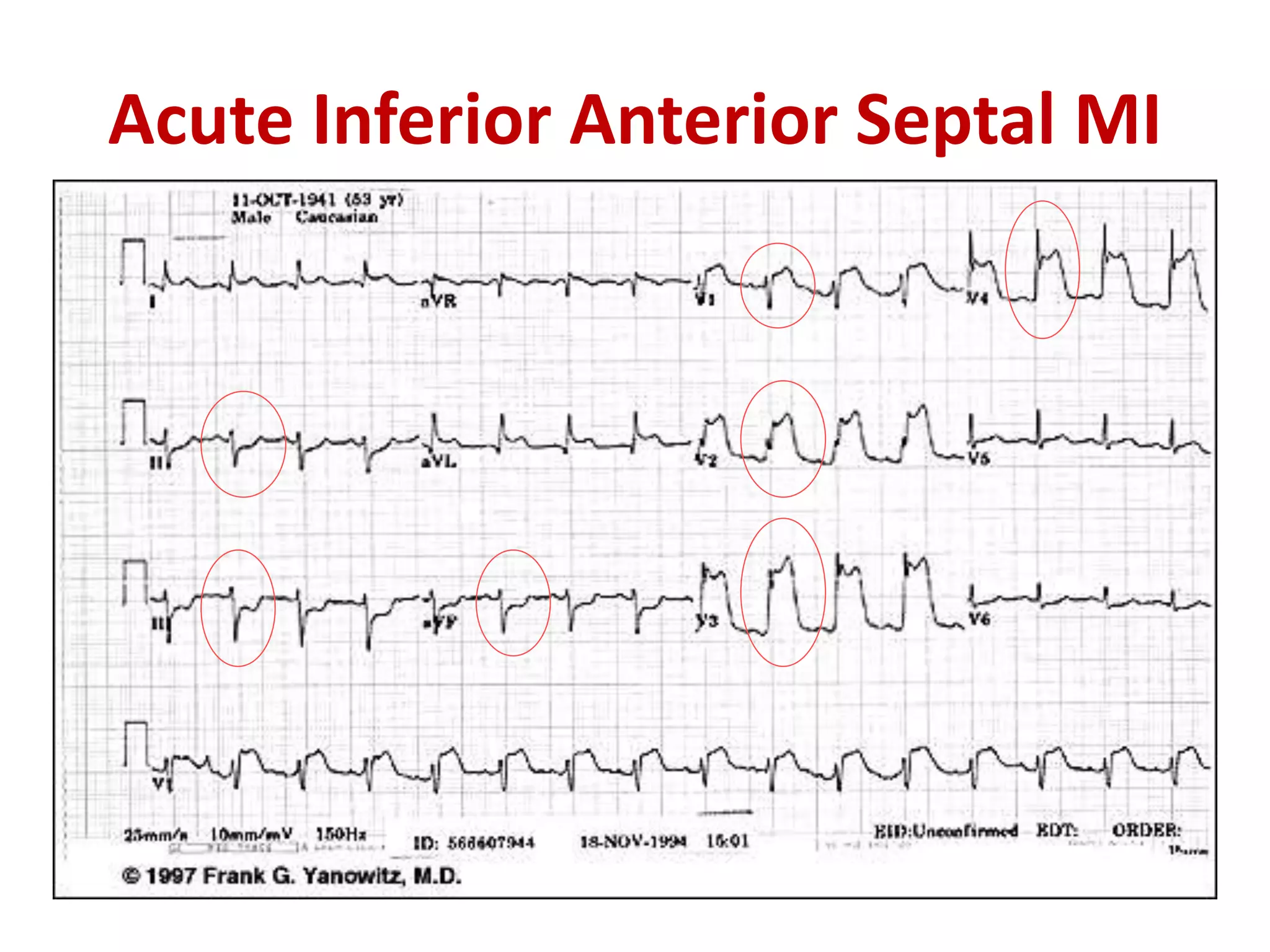 INTERPRETASI EKG 12 LEADS Infarct & Ischemia.pptx