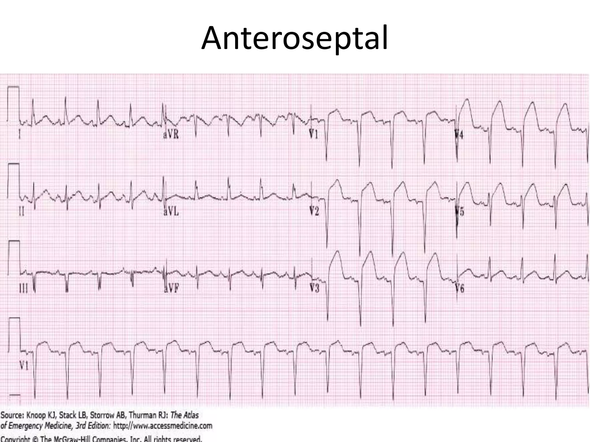 INTERPRETASI EKG 12 LEADS Infarct & Ischemia.pptx