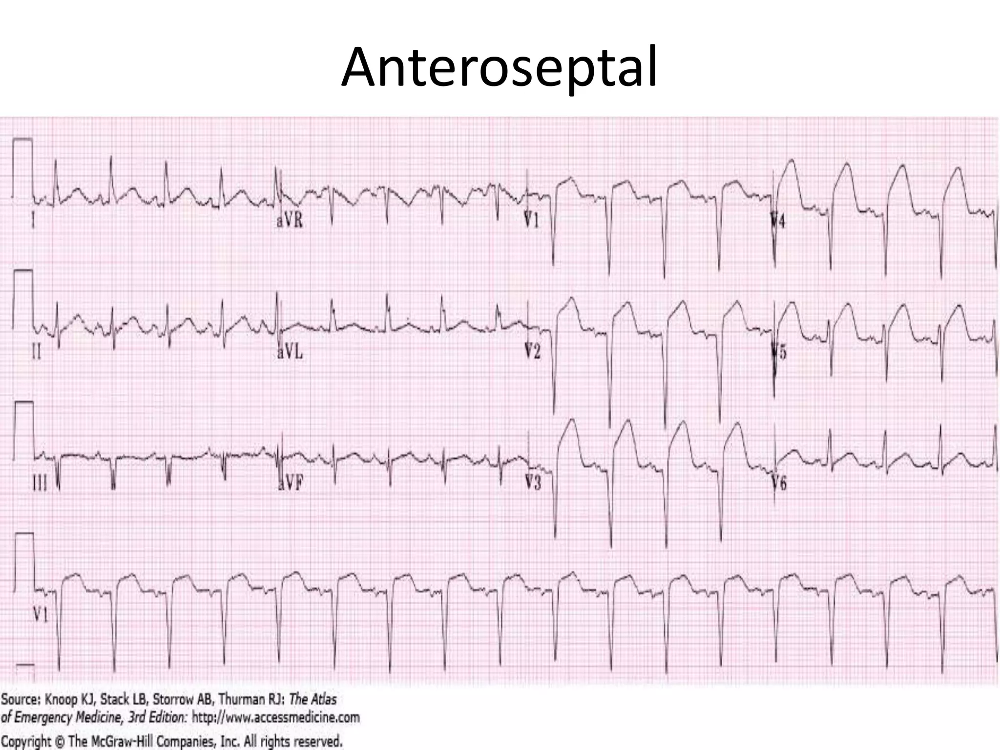 INTERPRETASI EKG 12 LEADS Infarct & Ischemia.pptx