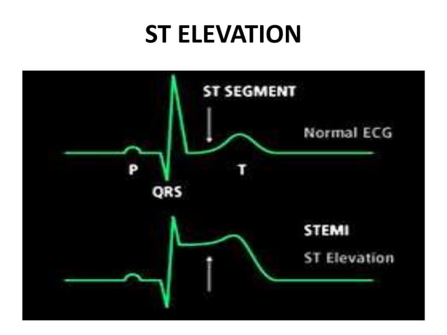 INTERPRETASI EKG 12 LEADS Infarct & Ischemia.pptx