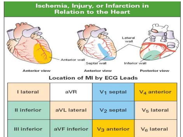 INTERPRETASI EKG 12 LEADS Infarct & Ischemia.pptx