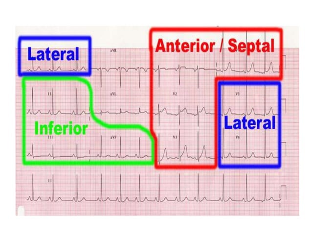 INTERPRETASI EKG 12 LEADS Infarct & Ischemia.pptx