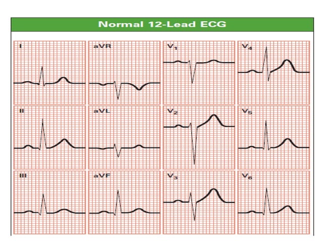 INTERPRETASI EKG 12 LEADS Infarct & Ischemia.pptx