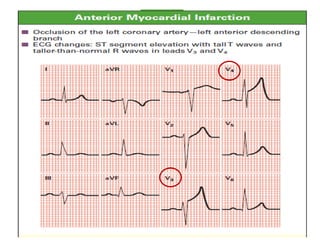INTERPRETASI EKG 12 LEADS Infarct & Ischemia.pptx