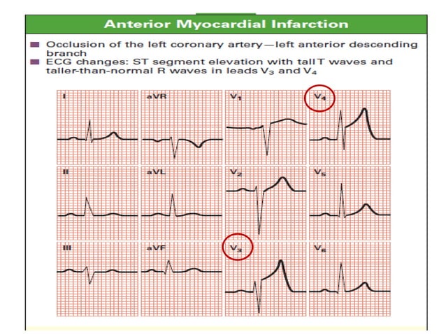 INTERPRETASI EKG 12 LEADS Infarct & Ischemia.pptx