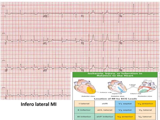 INTERPRETASI EKG 12 LEADS Infarct & Ischemia.pptx