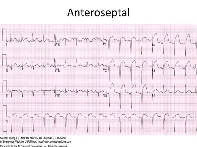 INTERPRETASI EKG 12 LEADS Infarct & Ischemia.pptx