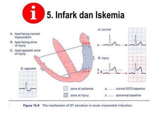 INTERPRETASI EKG 12 LEADS Infarct & Ischemia.pptx