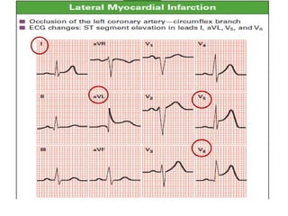INTERPRETASI EKG 12 LEADS Infarct & Ischemia.pptx