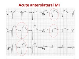 INTERPRETASI EKG 12 LEADS Infarct & Ischemia.pptx