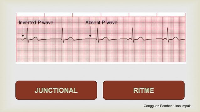 belajar Interpretasi EKG menyenangkan untuk pemula | PPT