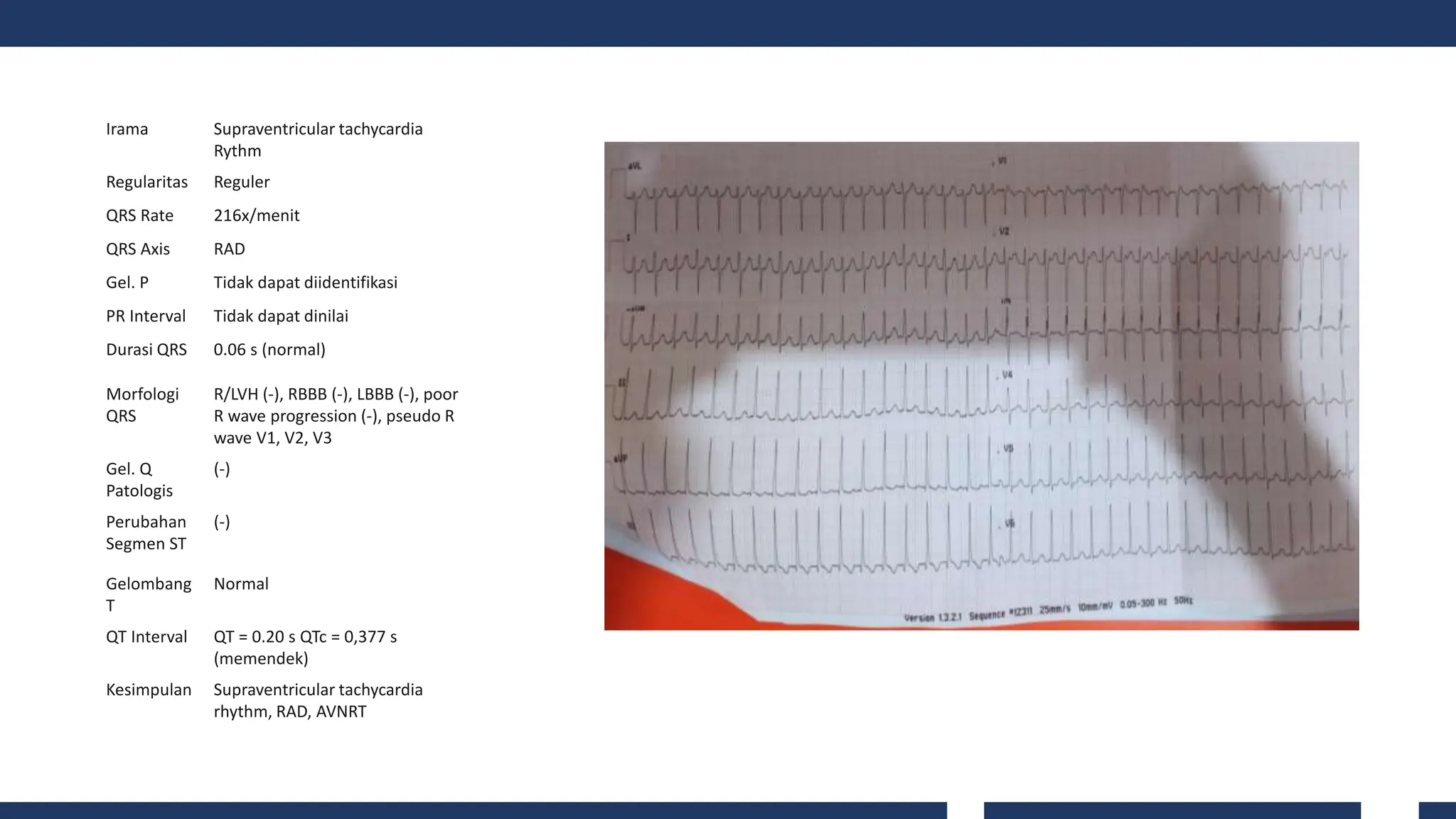 interpretasi ekg stase kardio perifer RSAA.pptx