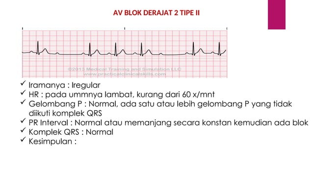 Interpretasi Gambaran EKG Bagi pemula.ppt
