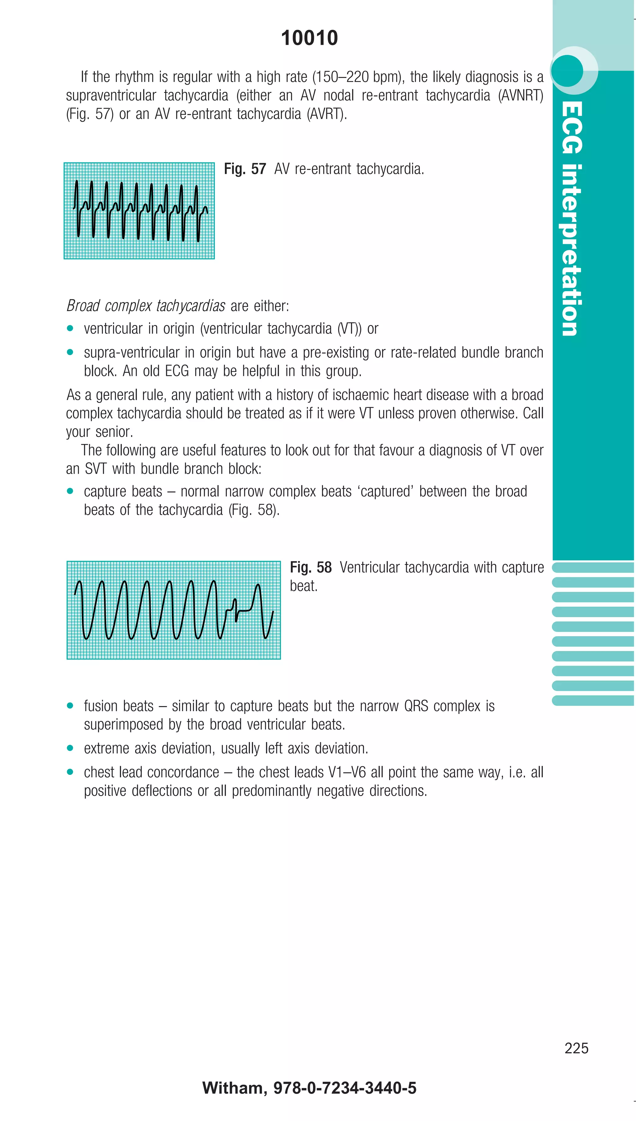 ECG Interpretation | PDF