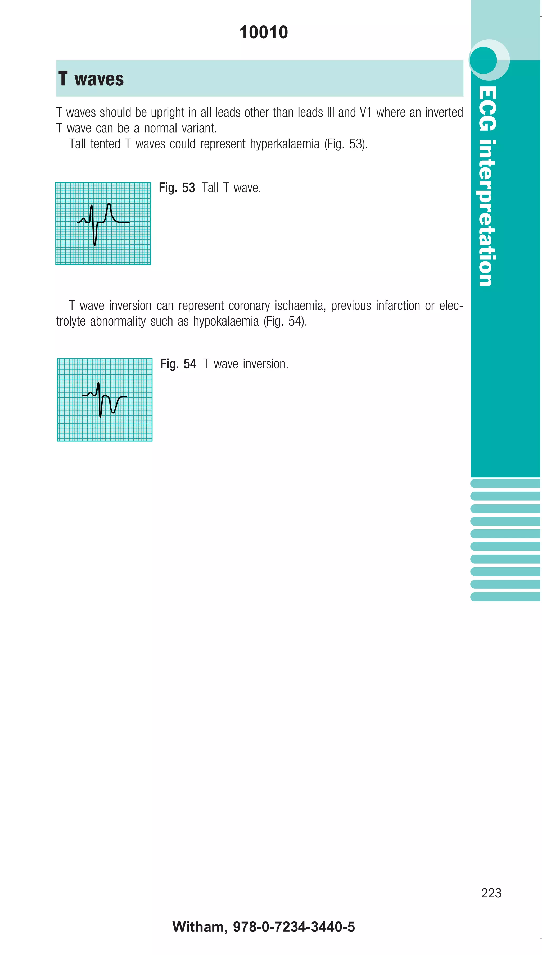 ECG Interpretation | PDF