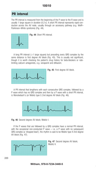 ECG Interpretation | PDF